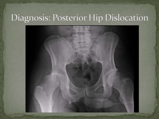 Posterior Hip Dislocation | PPTX