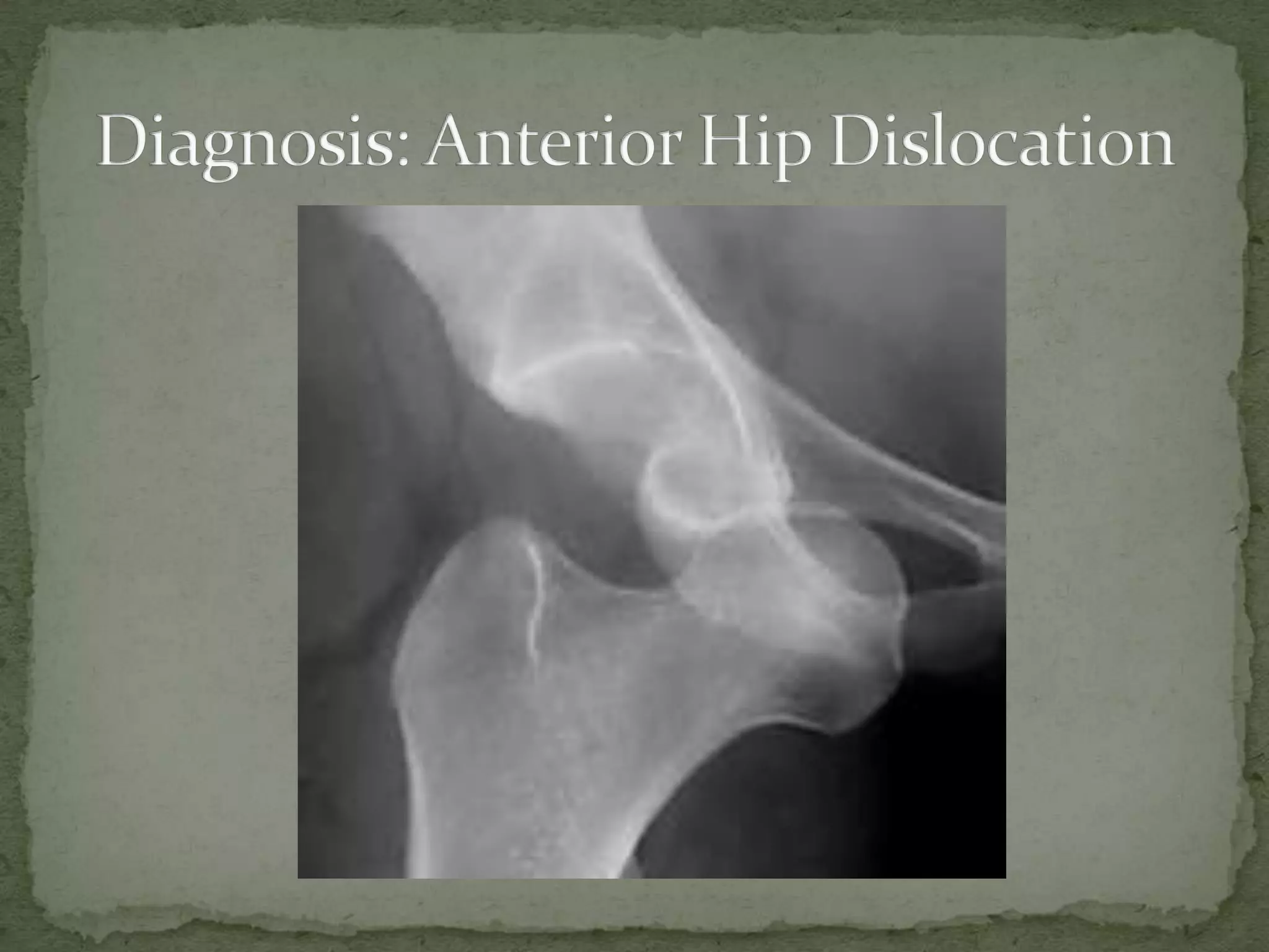 Anterior Hip Dislocation | PPTX