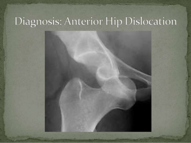 Anterior Hip Dislocation