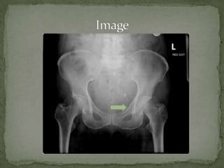 Pubic Rami Fracture | PPTX