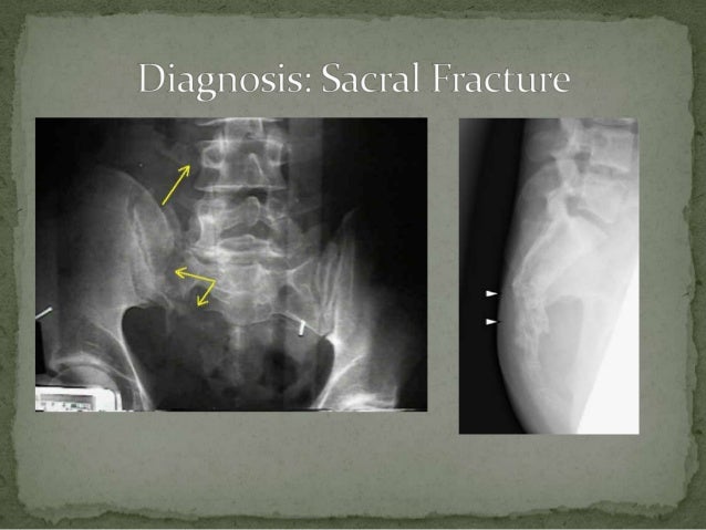 Sacral Fracture