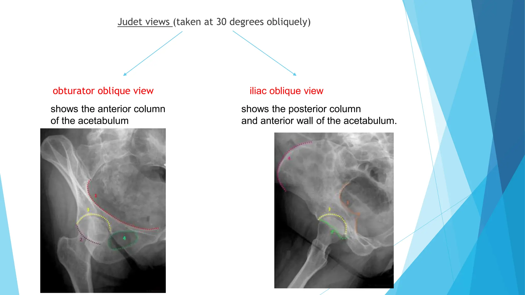PELVIS & ACETABULUM Orthopaedics topics slides | PPTX