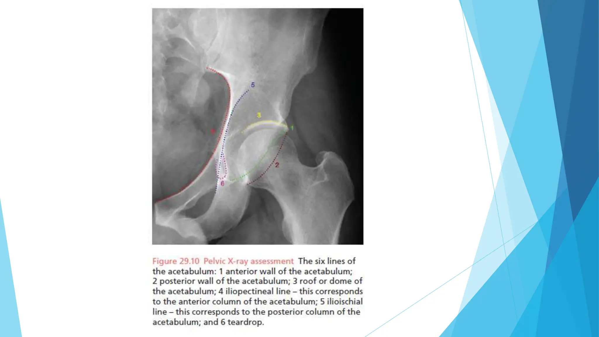 PELVIS & ACETABULUM Orthopaedics topics slides | PPTX