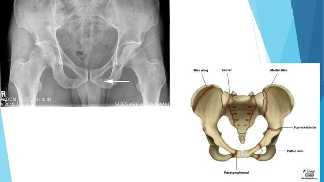 PELVIS & ACETABULUM Orthopaedics topics slides | PPT