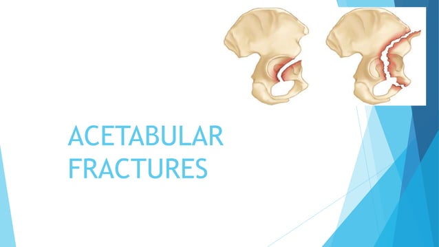PELVIS & ACETABULUM Orthopaedics topics slides | PPT