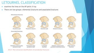 PELVIS & ACETABULUM Orthopaedics topics slides | PPTX