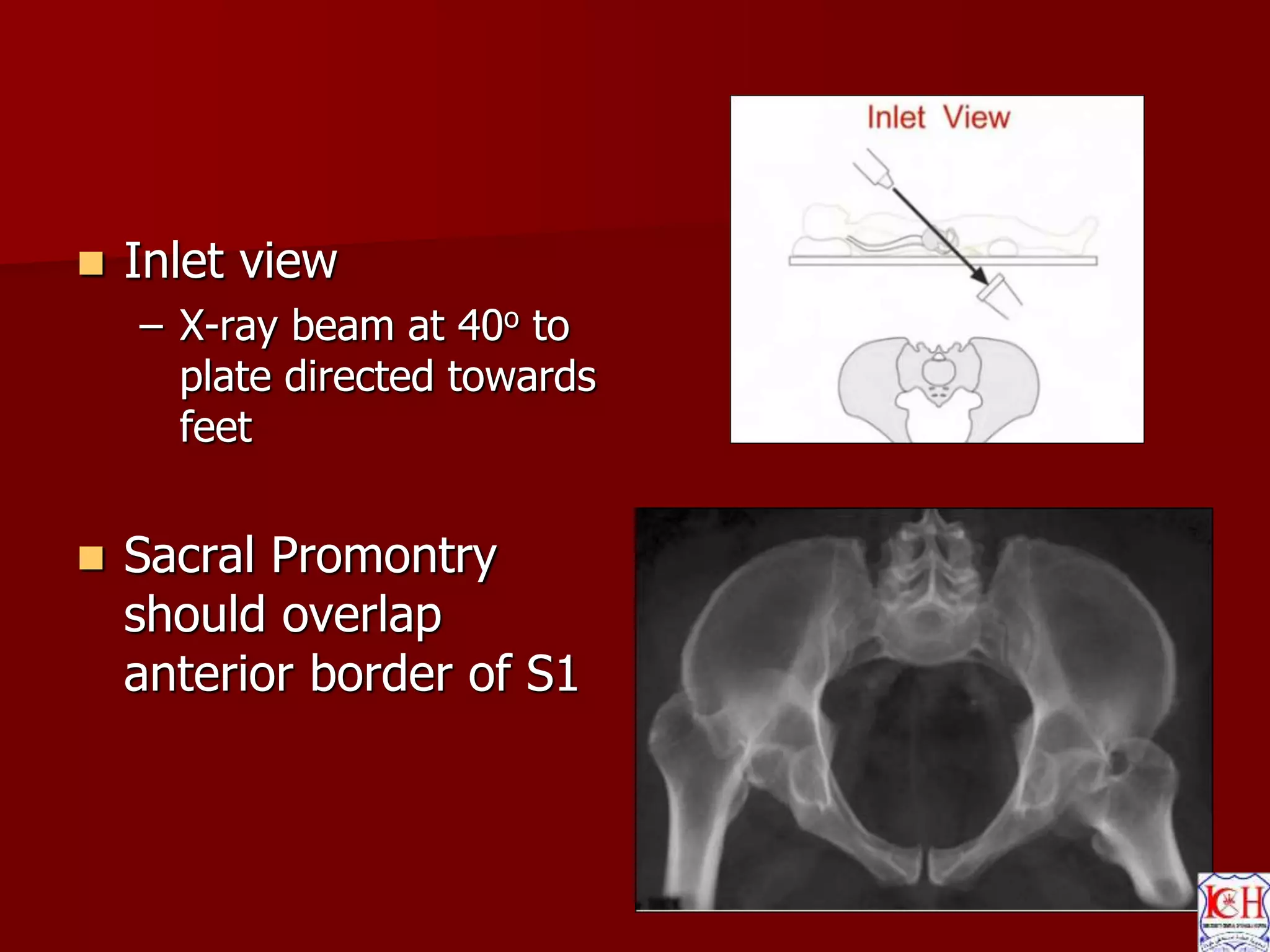 Pelvis acetabulum - anatomy , imaging , classification | PPTX