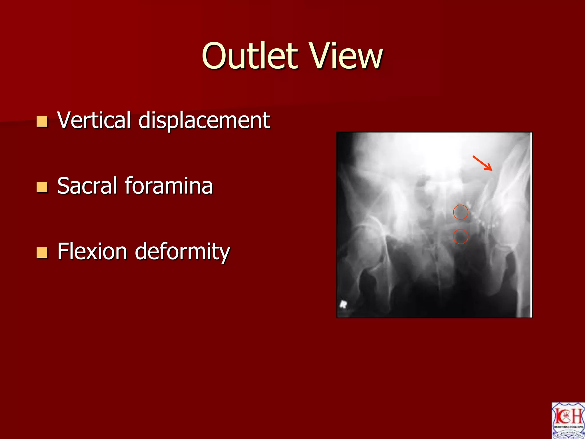 Pelvis acetabulum - anatomy , imaging , classification | PPTX