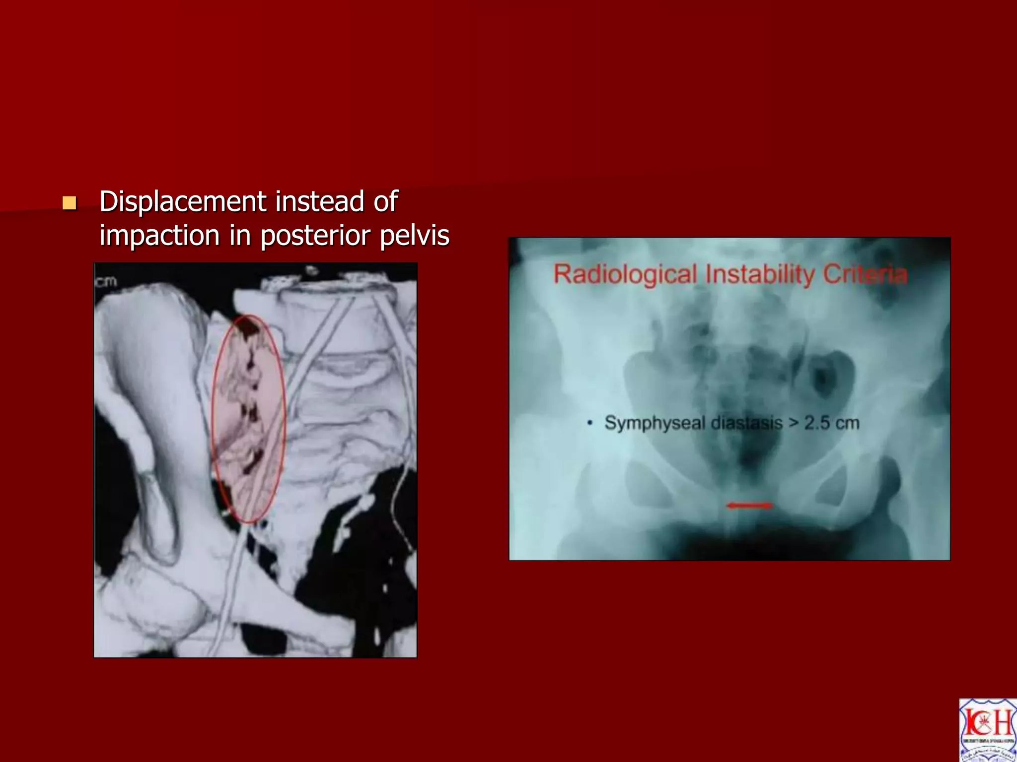 Pelvis acetabulum - anatomy , imaging , classification | PPTX