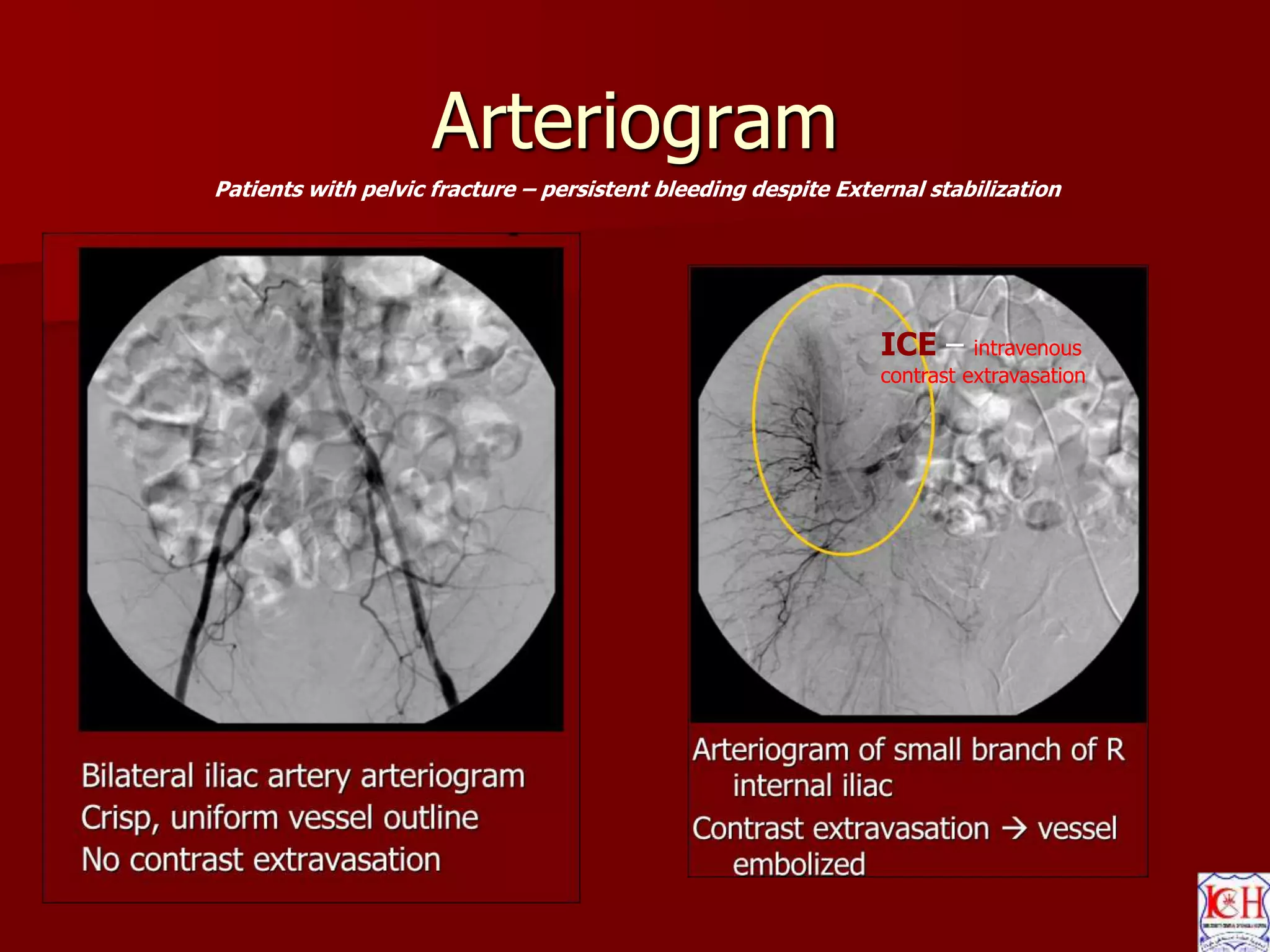 Pelvis acetabulum - anatomy , imaging , classification | PPTX
