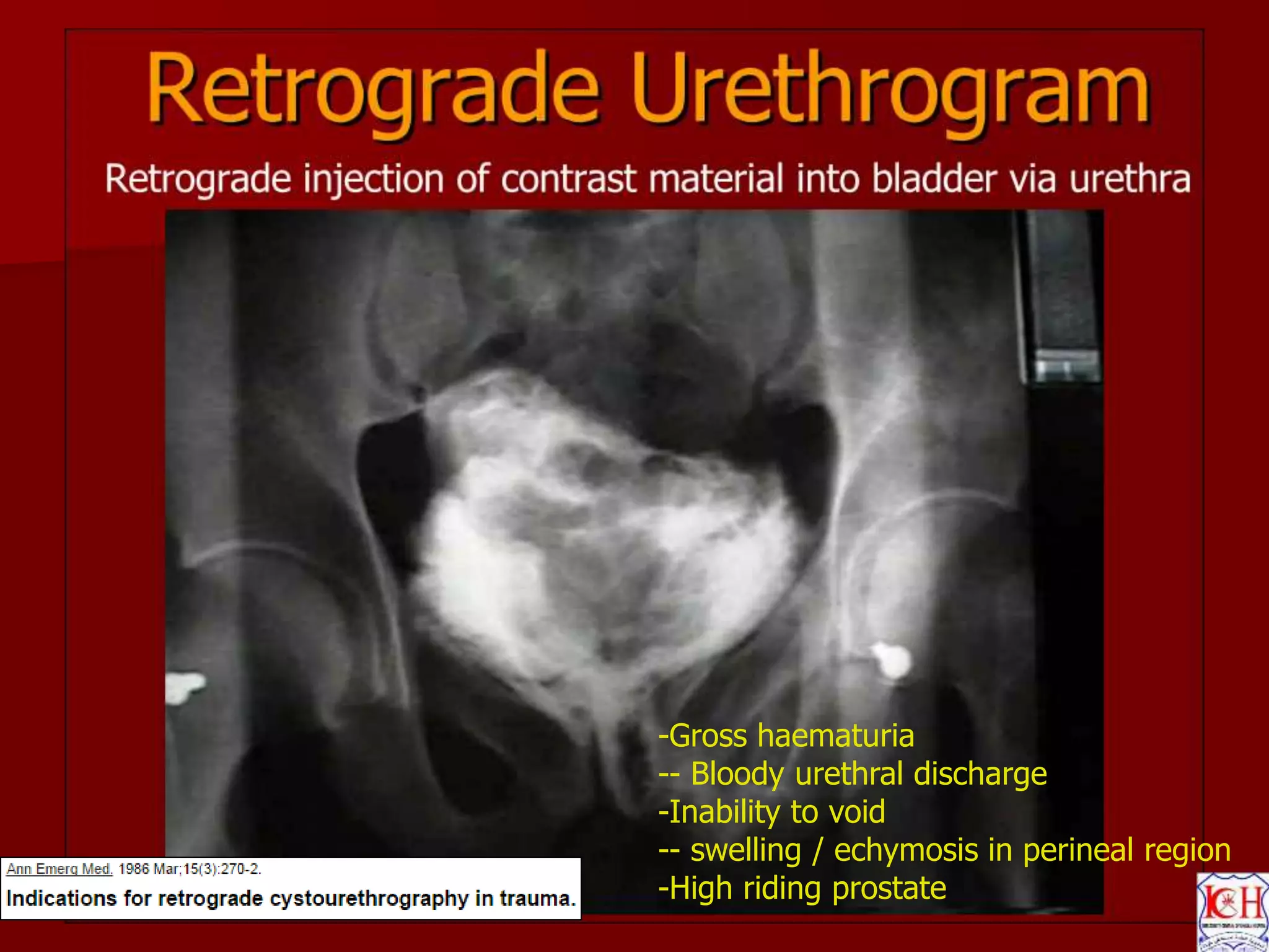Pelvis acetabulum - anatomy , imaging , classification | PPTX