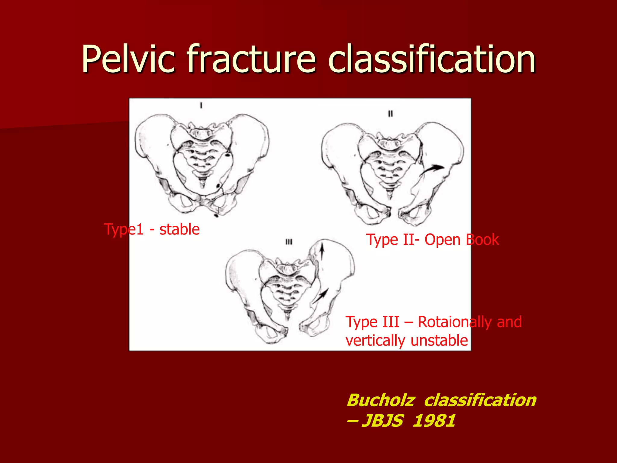 Pelvis acetabulum - anatomy , imaging , classification | PPTX