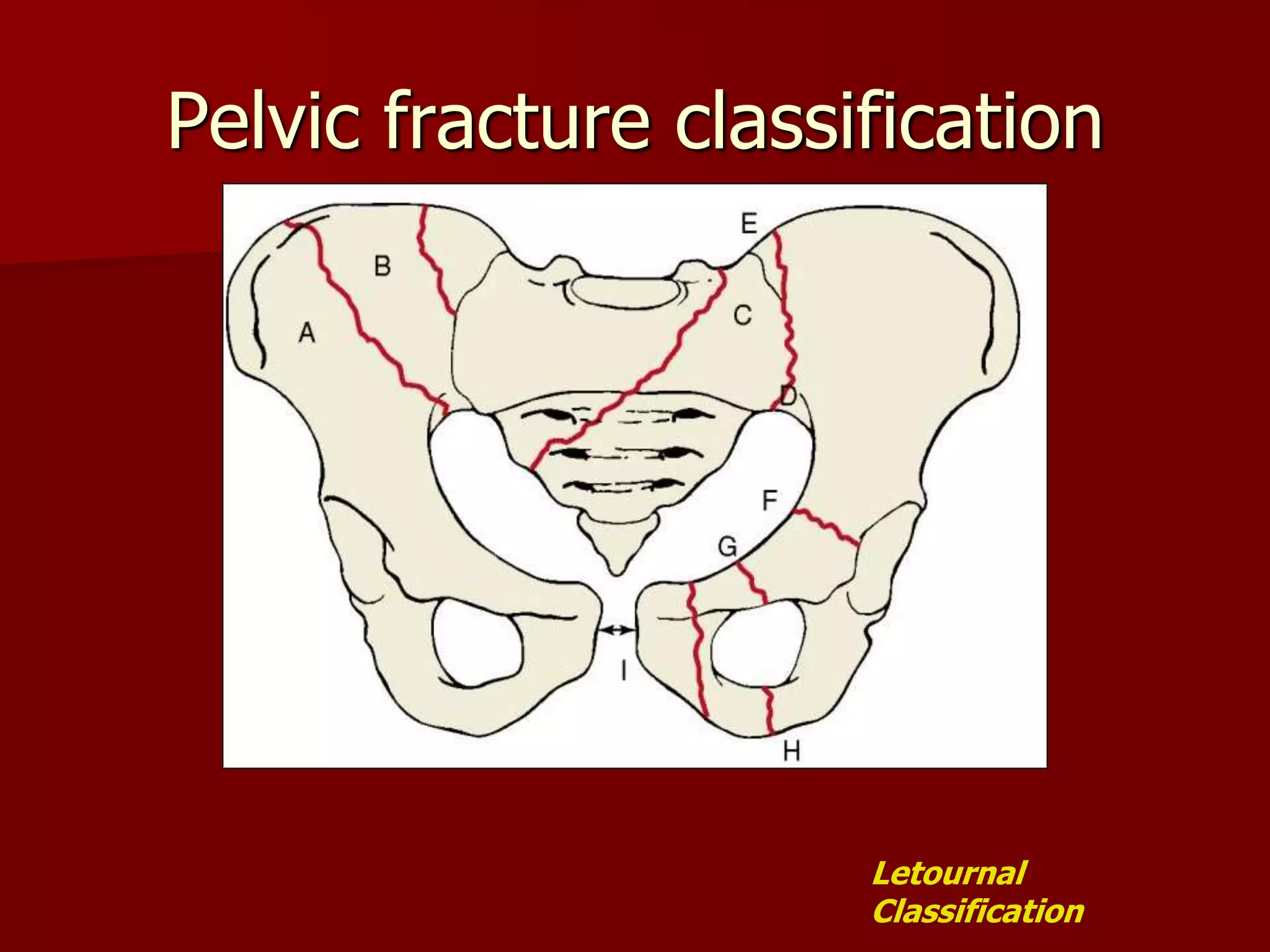 Pelvis acetabulum - anatomy , imaging , classification | PPTX