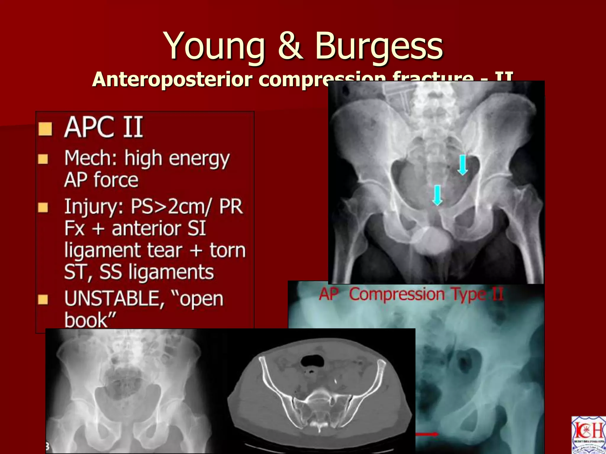 Pelvis acetabulum - anatomy , imaging , classification | PPTX
