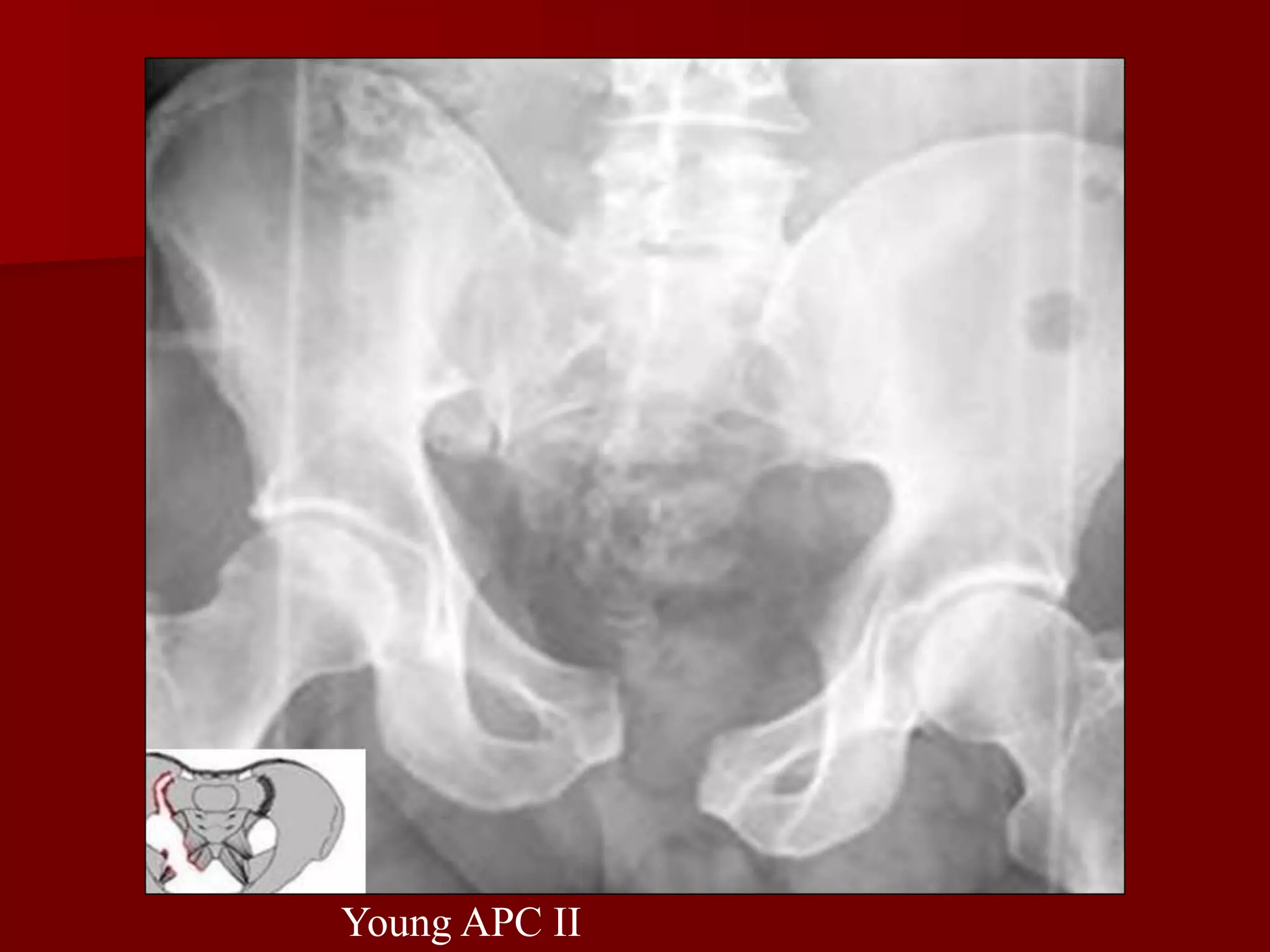 Pelvis acetabulum - anatomy , imaging , classification | PPTX
