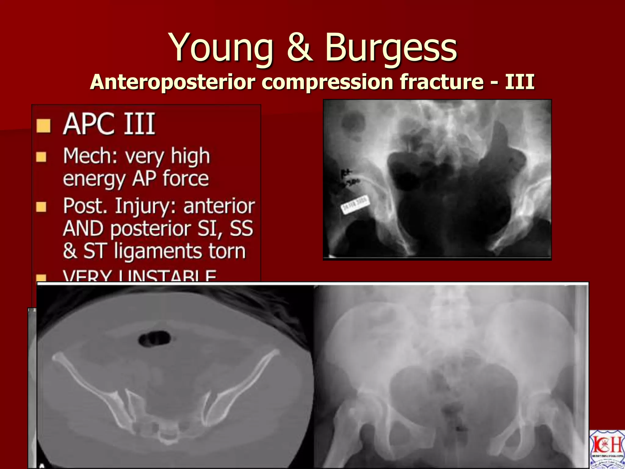 Pelvis acetabulum - anatomy , imaging , classification | PPTX