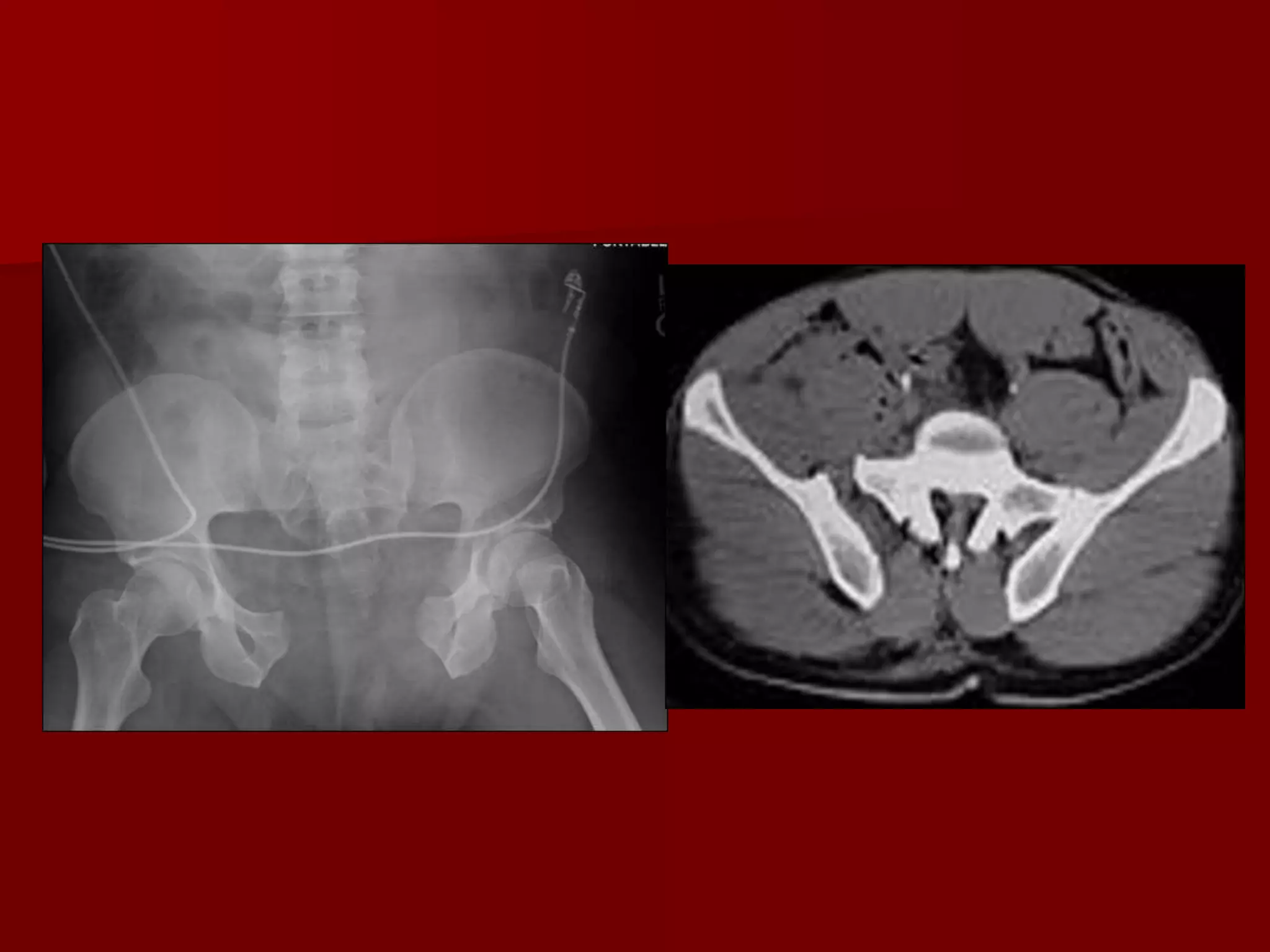 Pelvis acetabulum - anatomy , imaging , classification | PPTX