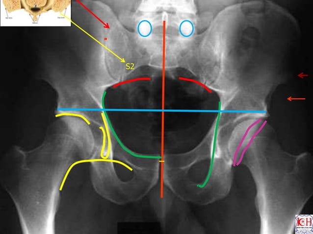 Pelvis acetabulum - anatomy , imaging , classification | PPTX