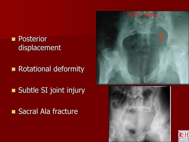 Pelvis acetabulum - anatomy , imaging , classification | PPTX