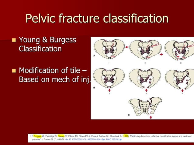 Pelvis acetabulum - anatomy , imaging , classification | PPTX