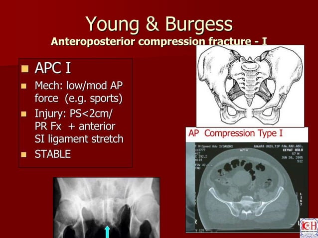 Pelvis acetabulum - anatomy , imaging , classification | PPT
