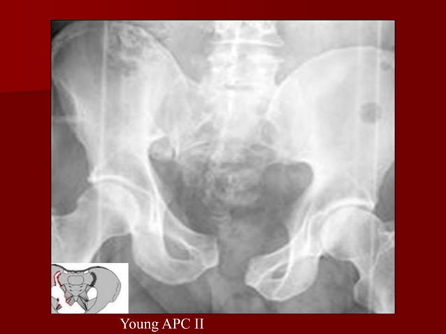 Pelvis acetabulum - anatomy , imaging , classification | PPTX