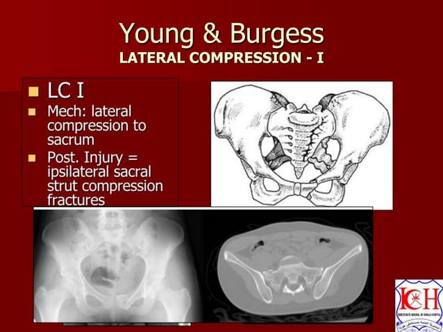 Pelvis acetabulum - anatomy , imaging , classification | PPTX