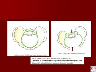 Pelvis acetabulum - anatomy , imaging , classification | PPTX