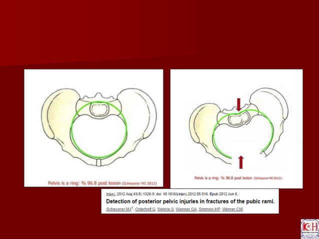 Pelvis acetabulum - anatomy , imaging , classification | PPTX