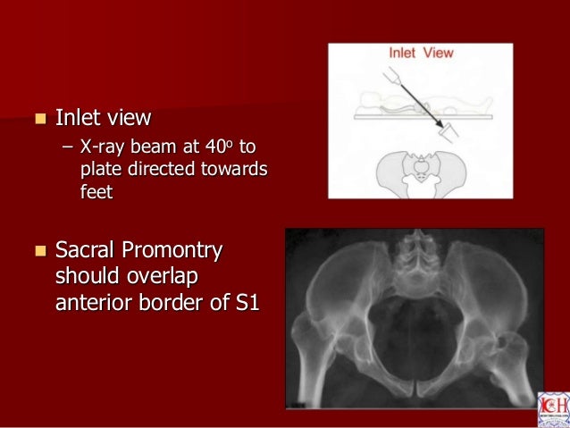 Pelvis acetabulum - anatomy , imaging , classification