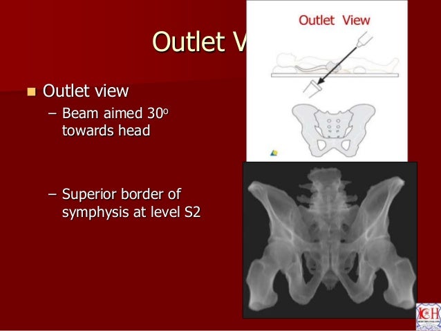 Pelvis acetabulum - anatomy , imaging , classification