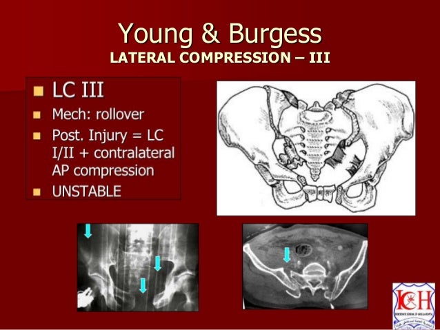 Pelvis acetabulum - anatomy , imaging , classification