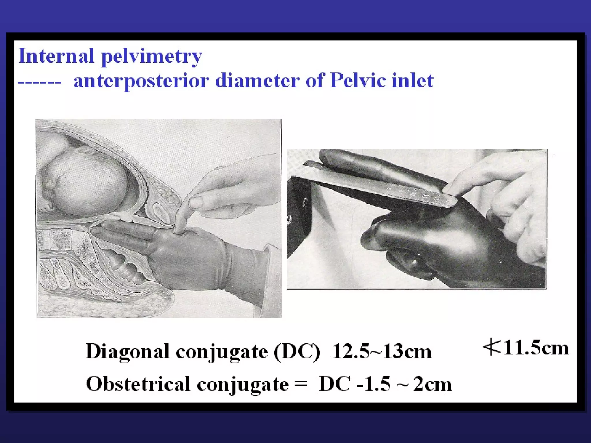Pelvis and pelvimetry | PPT