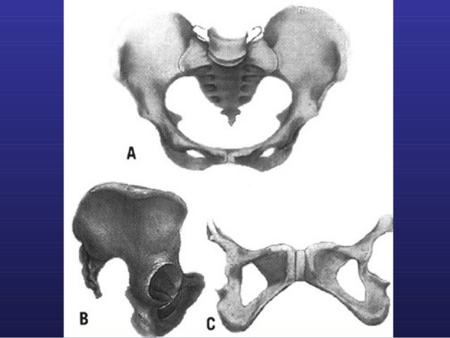 Pelvis and pelvimetry