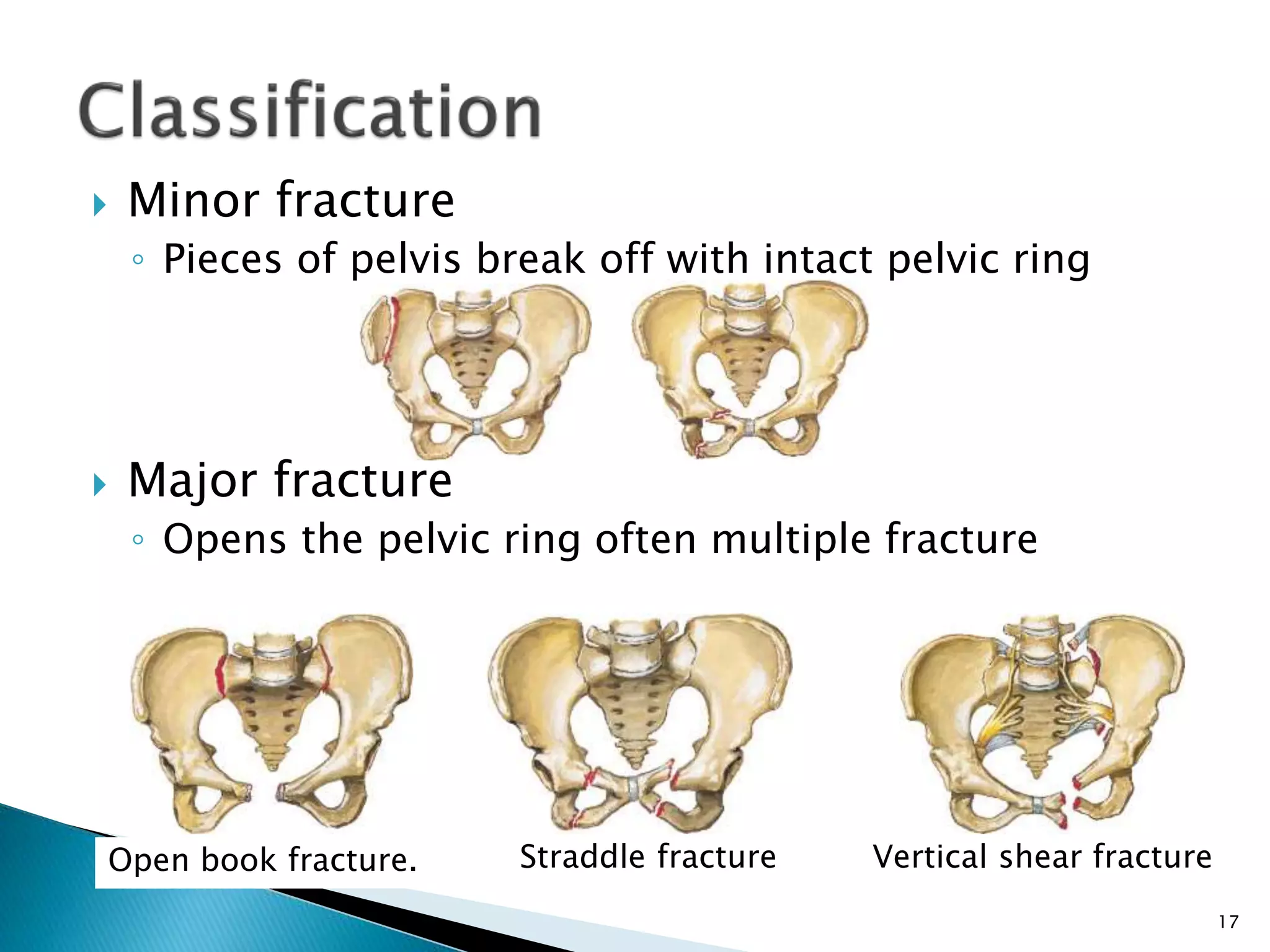 Pelvis and perineum | PPTX