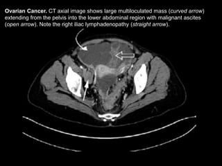 Pelvis ct pathology | PPTX