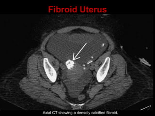 Pelvis ct pathology | PPTX