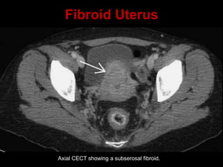 Pelvis ct pathology | PPTX