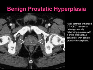 Pelvis ct pathology | PPTX