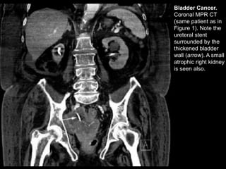 Pelvis ct pathology | PPTX