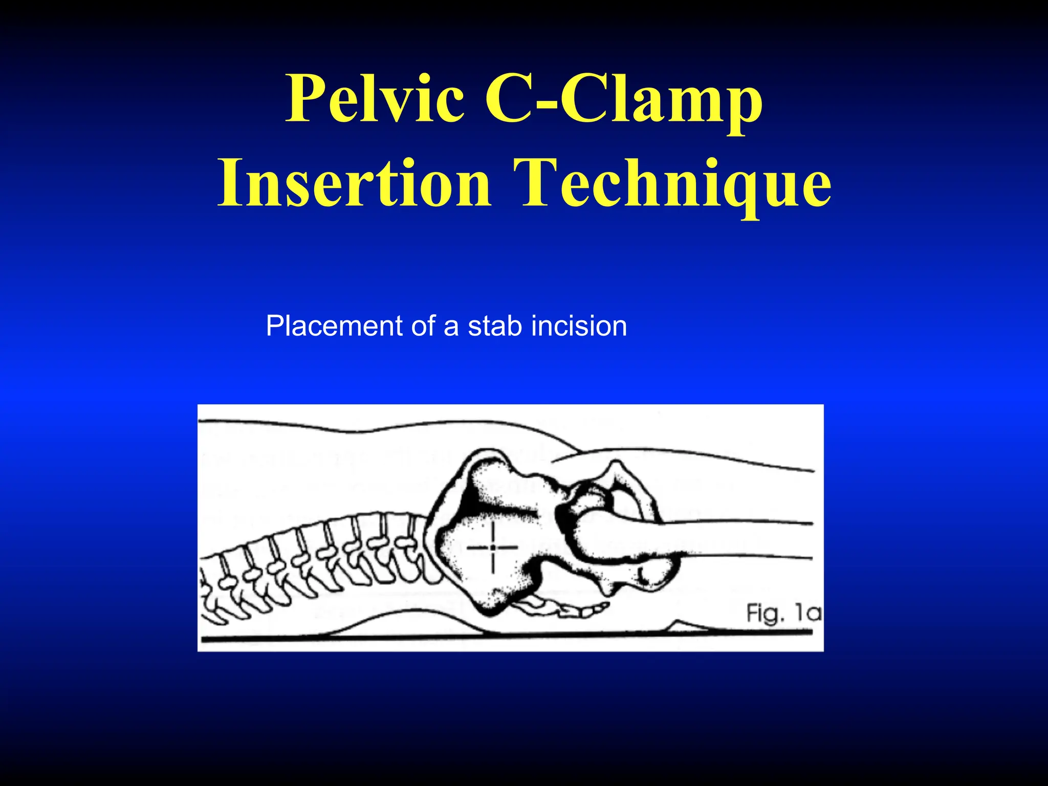 Pelvis Fracture.pdf