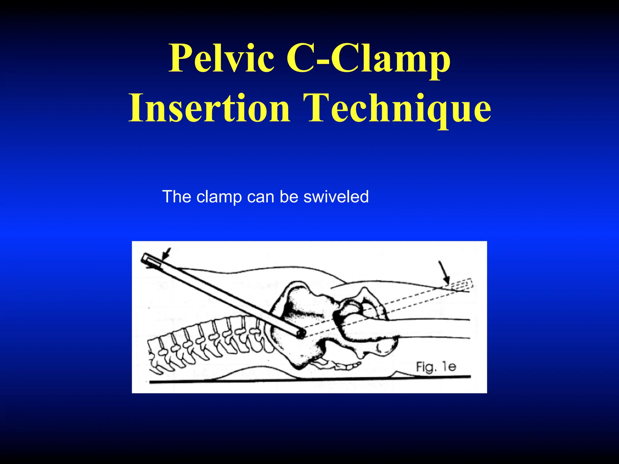 Pelvis Fracture.pdf