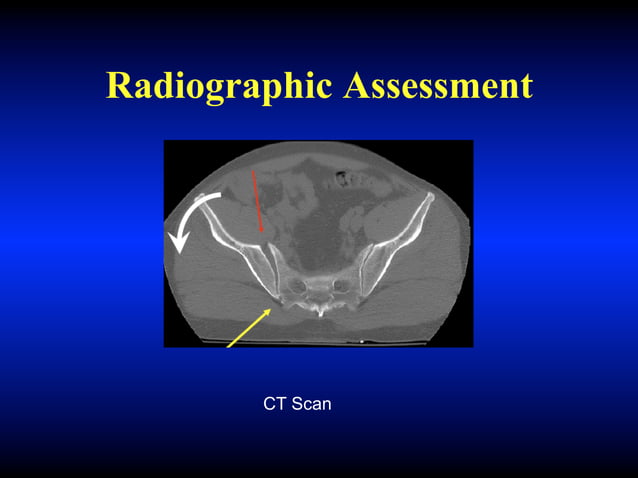 Pelvis Fracture.pdf