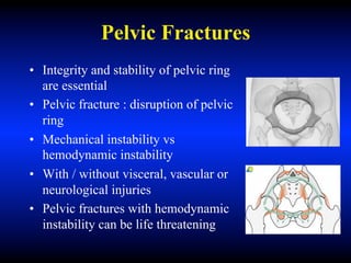 Pelvis Fracture.pdf