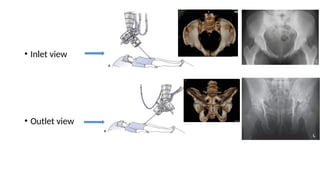 Pelvis fracture, classification and management | PPTX