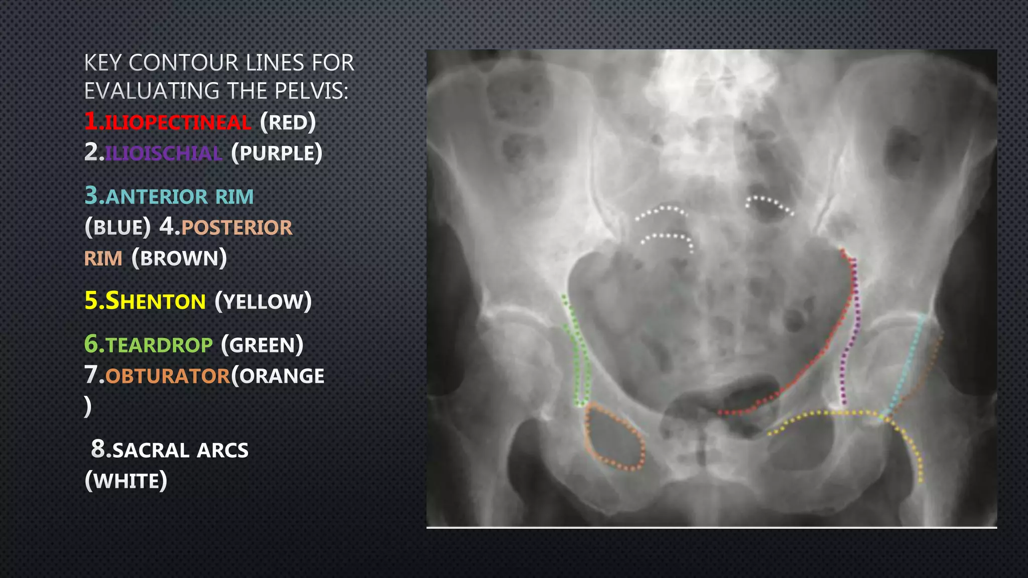 Pelvis fractures | PPTX