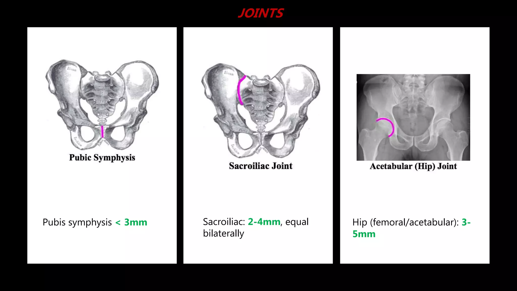Pelvis fractures | PPTX
