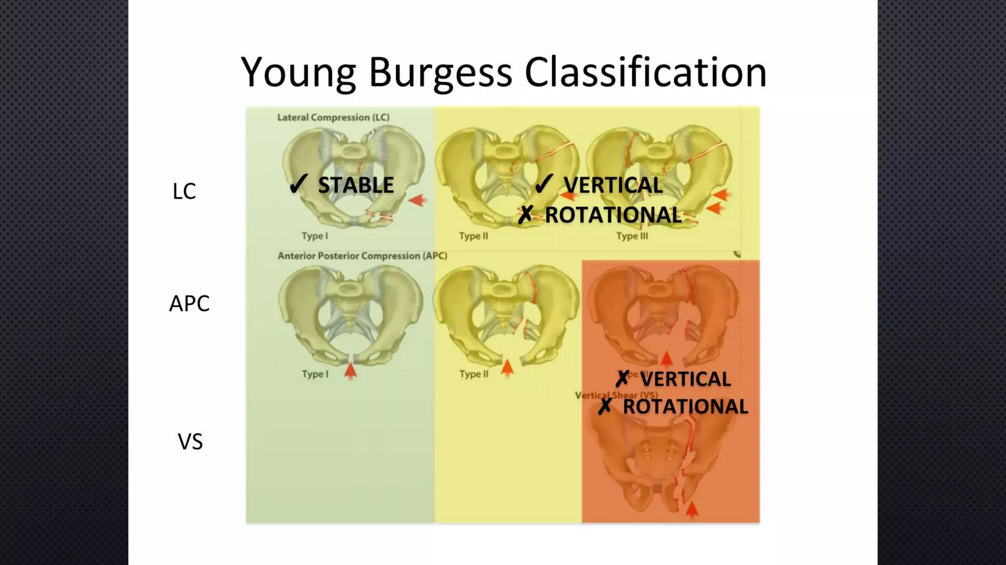 Pelvis fractures | PPTX