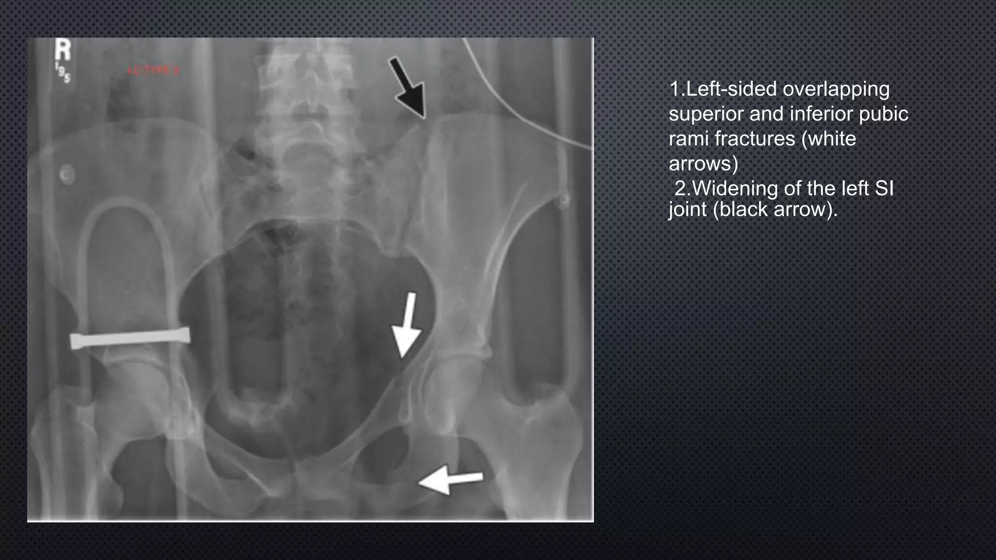 Pelvis fractures | PPTX