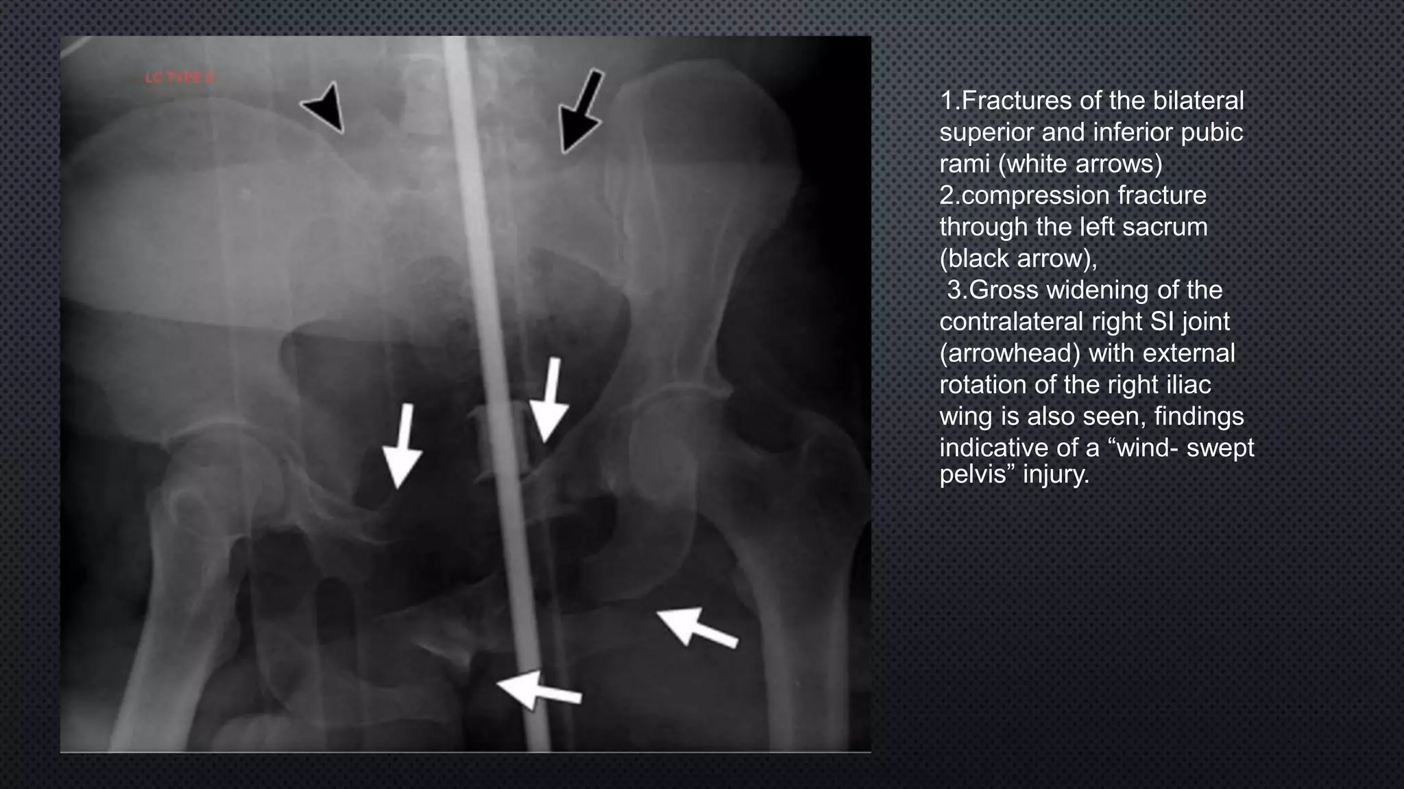 Pelvis fractures | PPTX